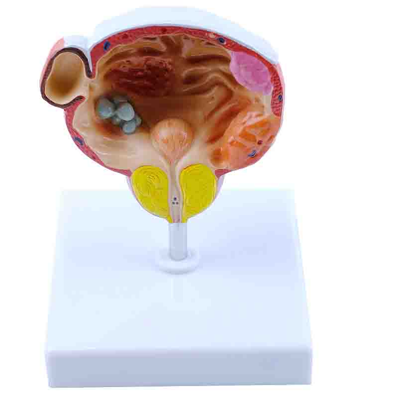 Diseases of Bladder and Prostate Model