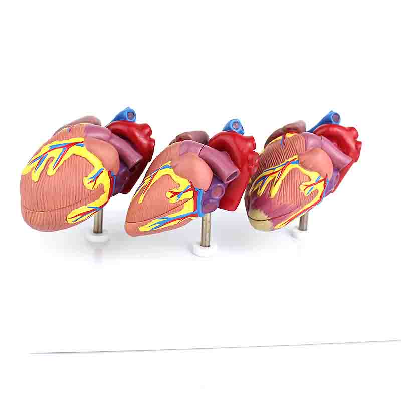 Heart Disease Model Set – Dr Wong Anatomy
