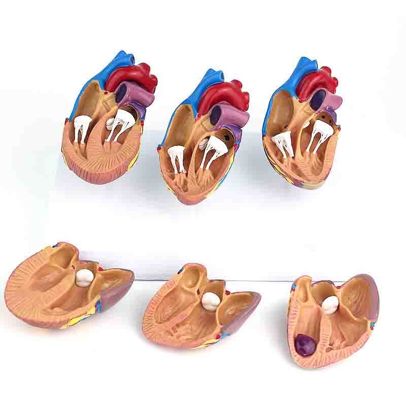 Heart Disease Model Set – Dr Wong Anatomy