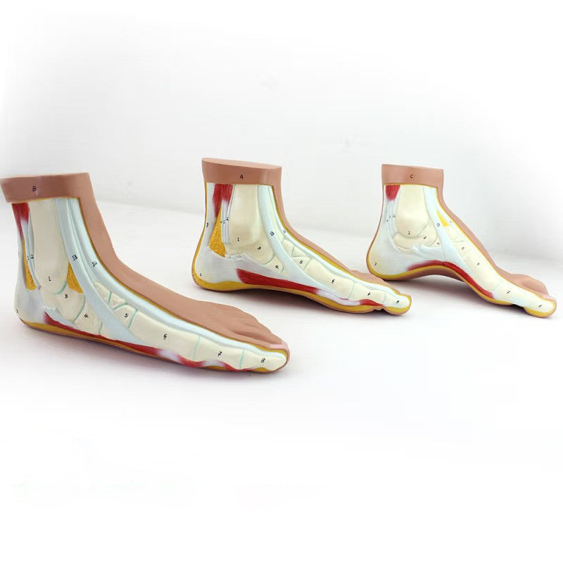 Model of Normal Foot, Flat Foot and High Arched Foot
