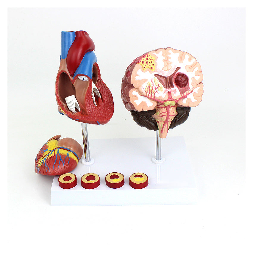 Hypertension Model