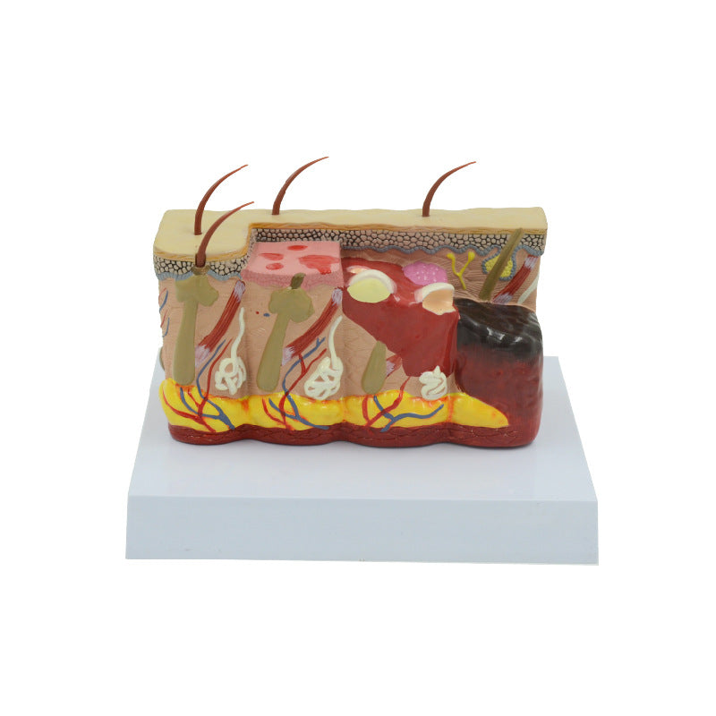 Pathological Model of Burned Skin