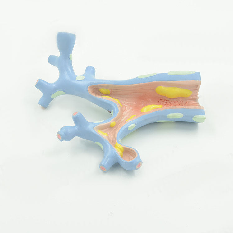 Pathology of the Human Trachea and Bronchi Model