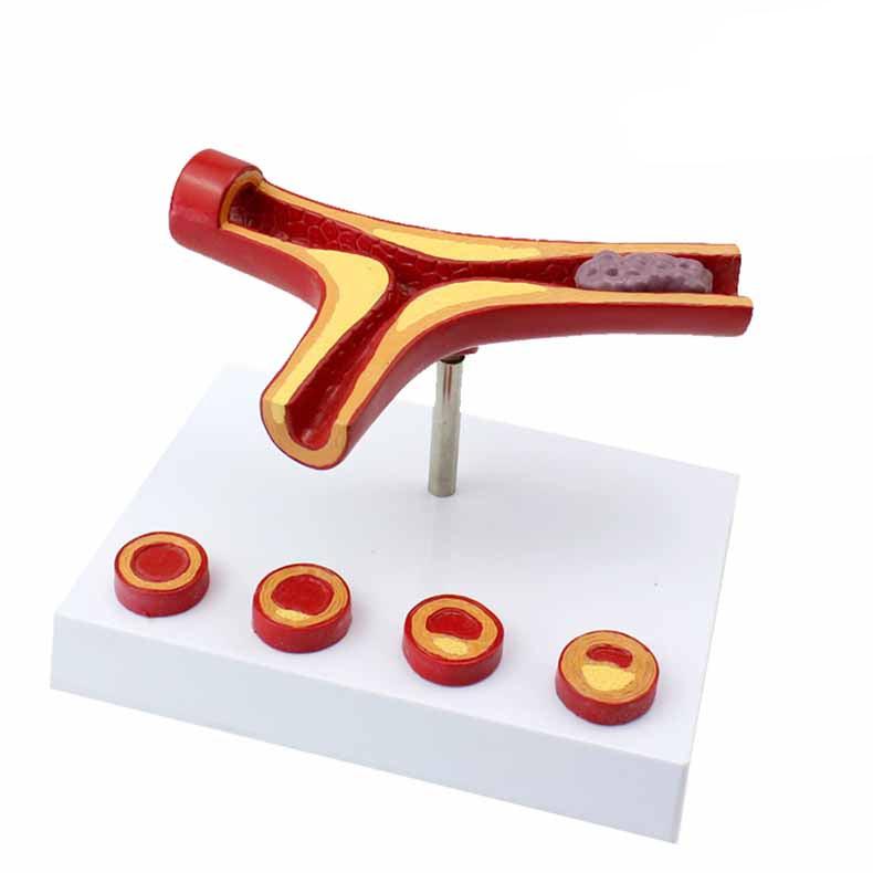 Arteriosclerosis Model, 4 Stages – Dr Wong Anatomy