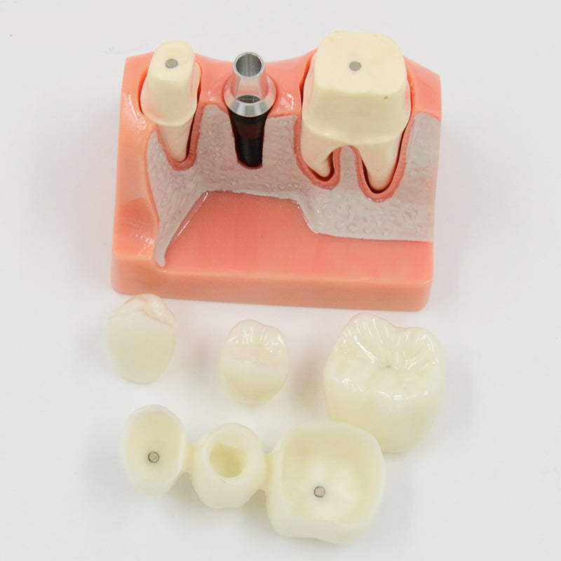 W2017 Dental Implant Model, 2.5X Life-Size