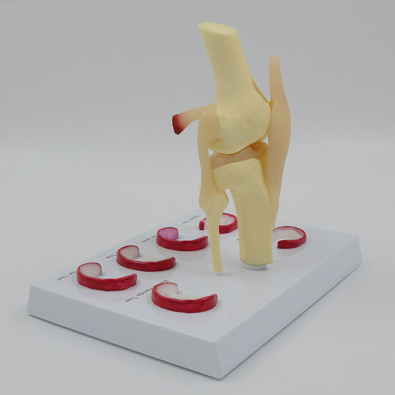 Knee Model with Meniscus Tears