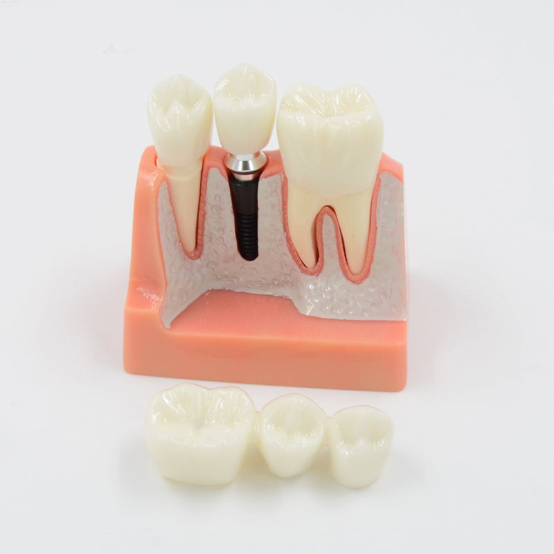 W2017 Dental Implant Model, 2.5X Life-Size