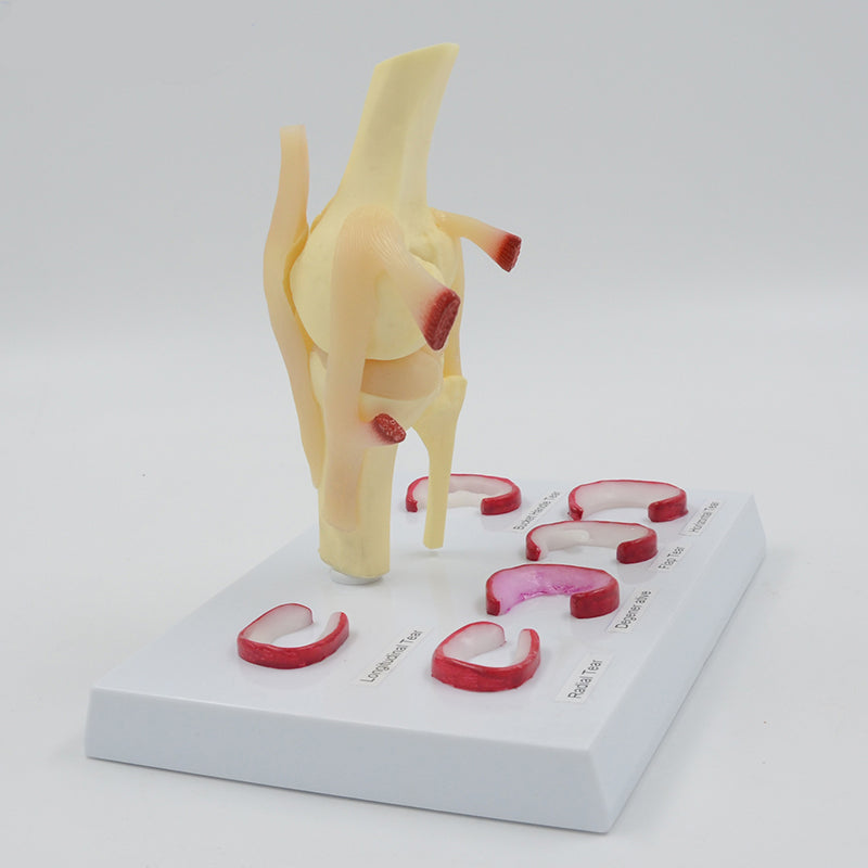 Knee Model with Meniscus Tears