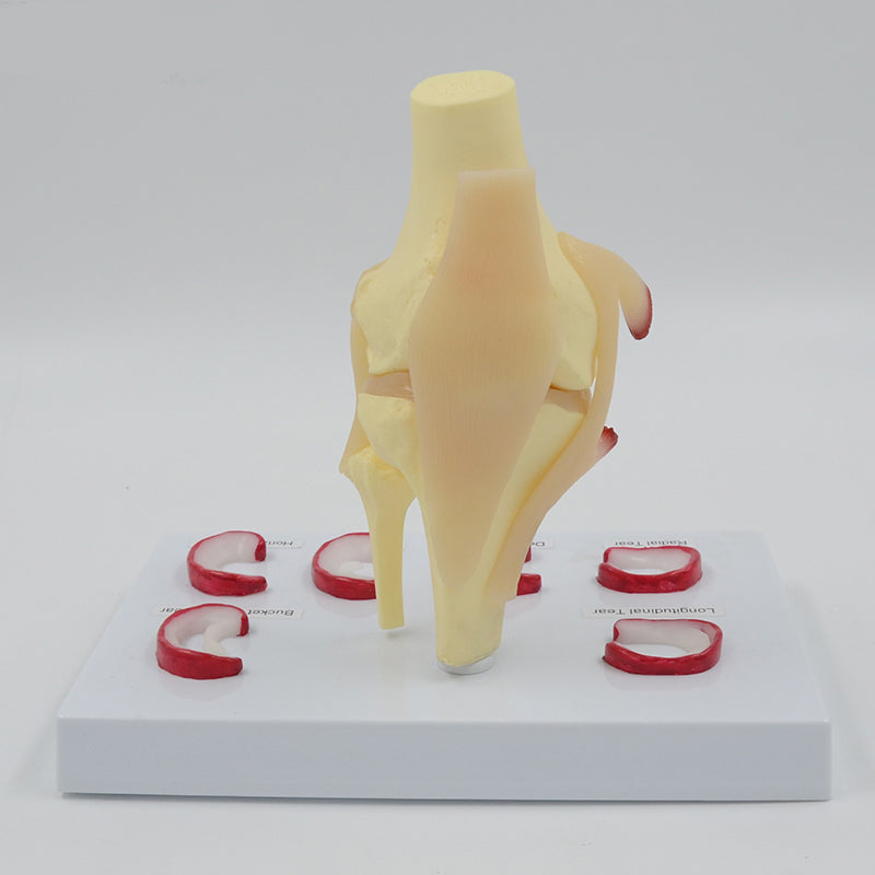 Knee Model with Meniscus Tears