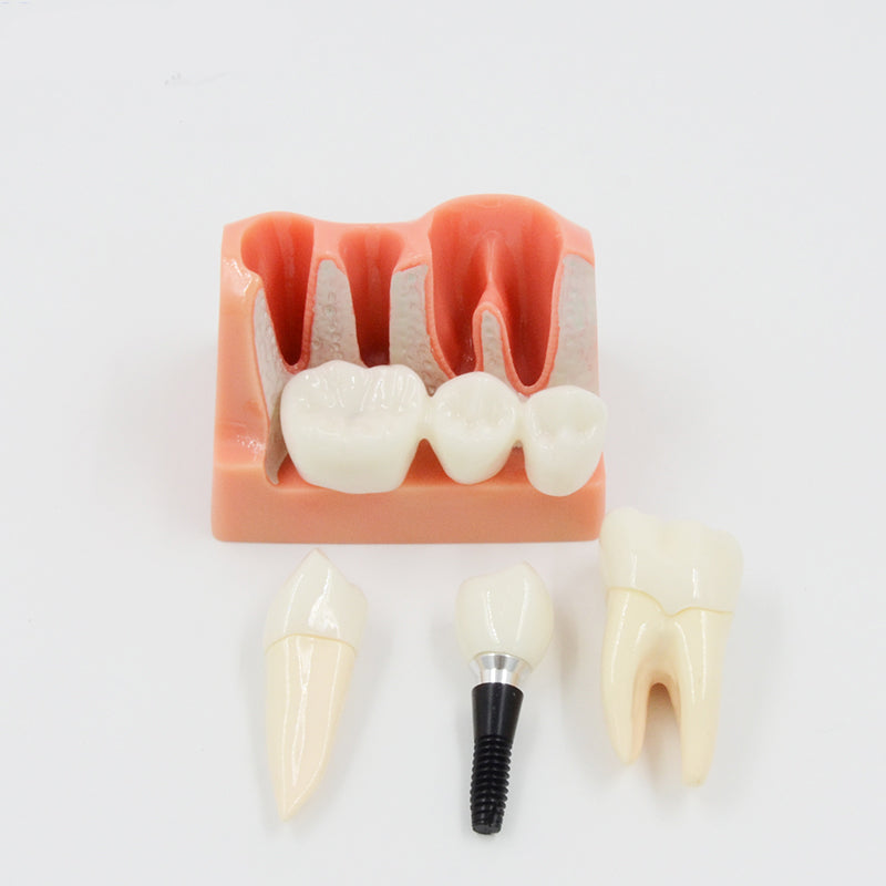 W2017 Dental Implant Model, 2.5X Life-Size