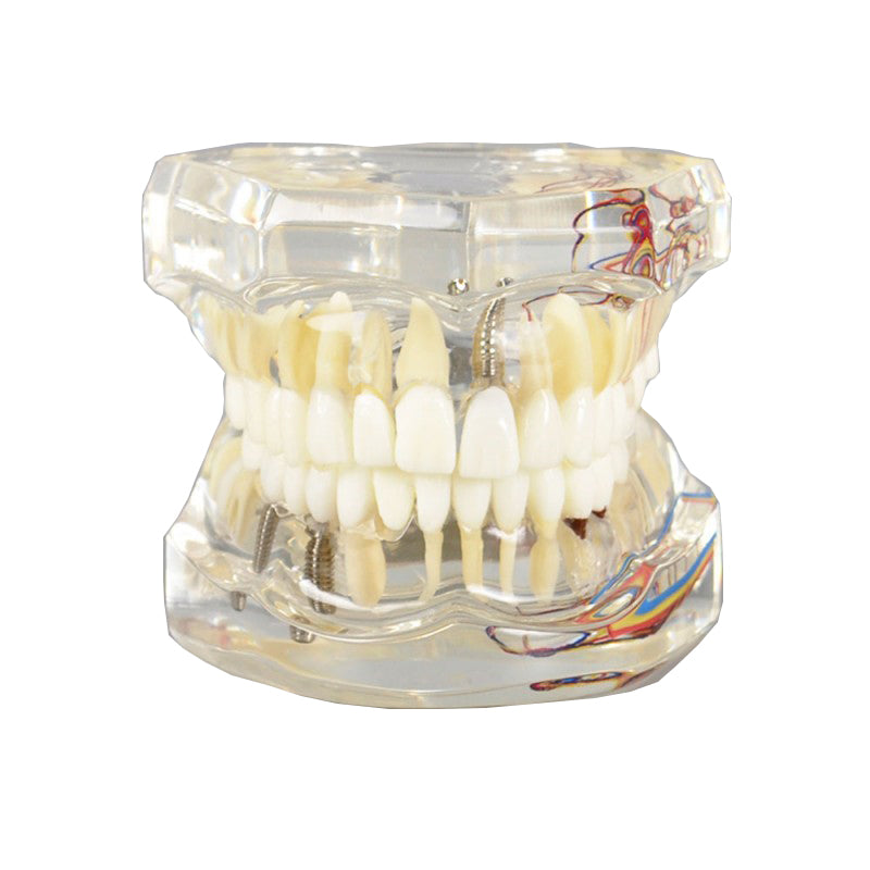 W2001-2 Dental Implant and Restoration Model with Nerve