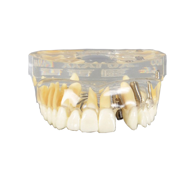 W2005-2 Dental Implant Model with Crown and Bridge