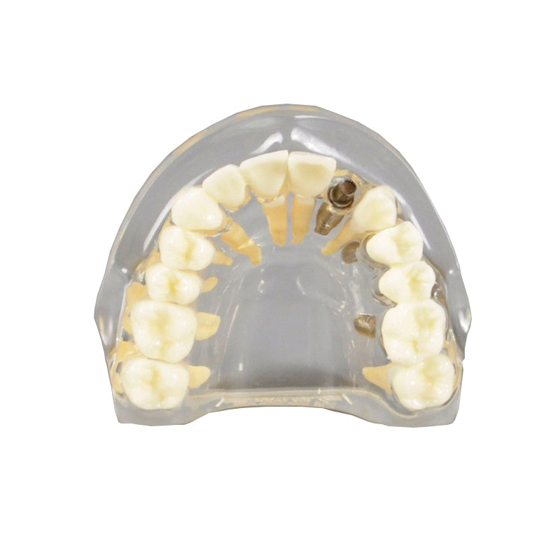 W2005-2 Dental Implant Model with Crown and Bridge