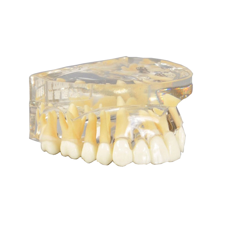 W2005-2 Dental Implant Model with Crown and Bridge