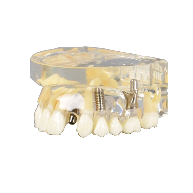 W2005-2 Dental Implant Model with Crown and Bridge