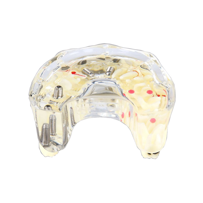 W2006 Dental Implant Model for Demonstration – Dr Wong Anatomy