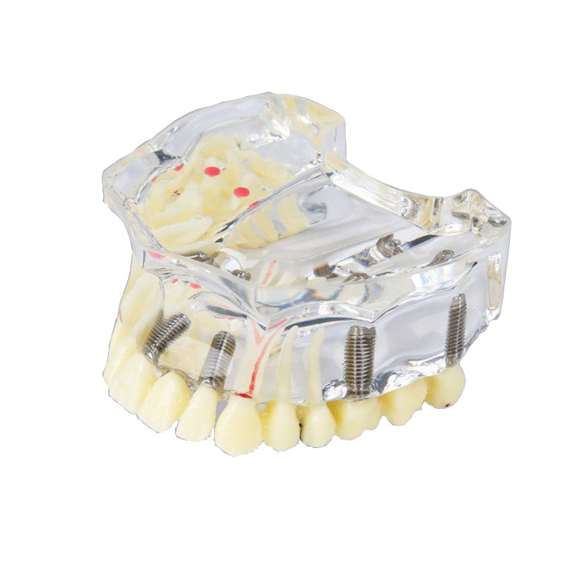 W2006 Dental Implant Model for Demonstration