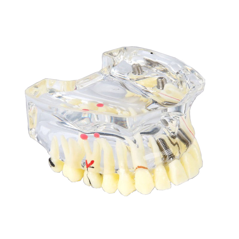 W2006 Dental Implant Model for Demonstration