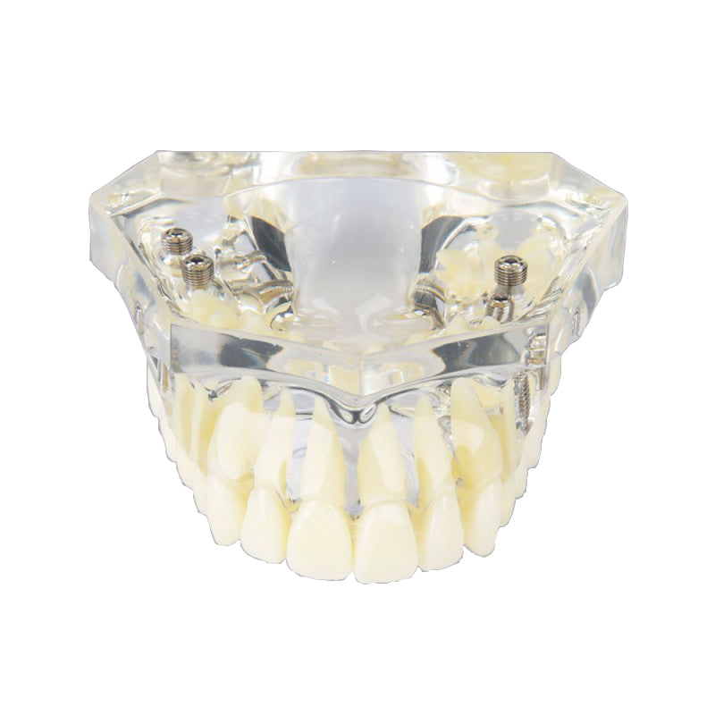 W2011 Dental Implant Model Maxillary Model with Crown and Implant – Dr ...