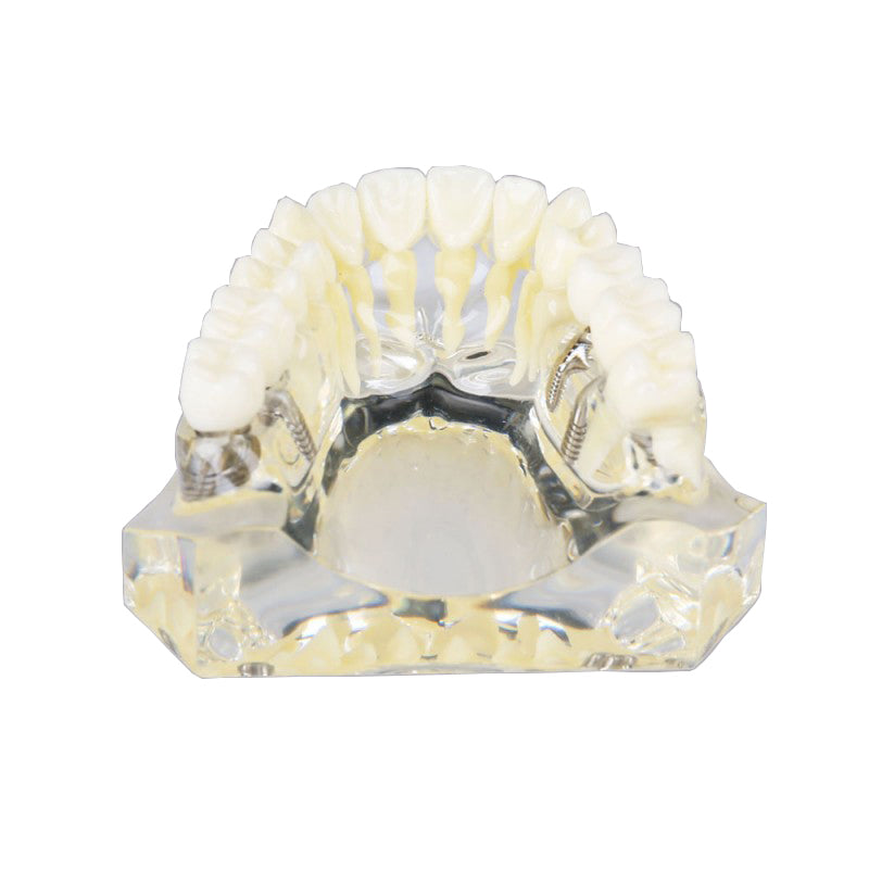 W2011 Dental Implant Model Maxillary Model with Crown and Implant – Dr ...
