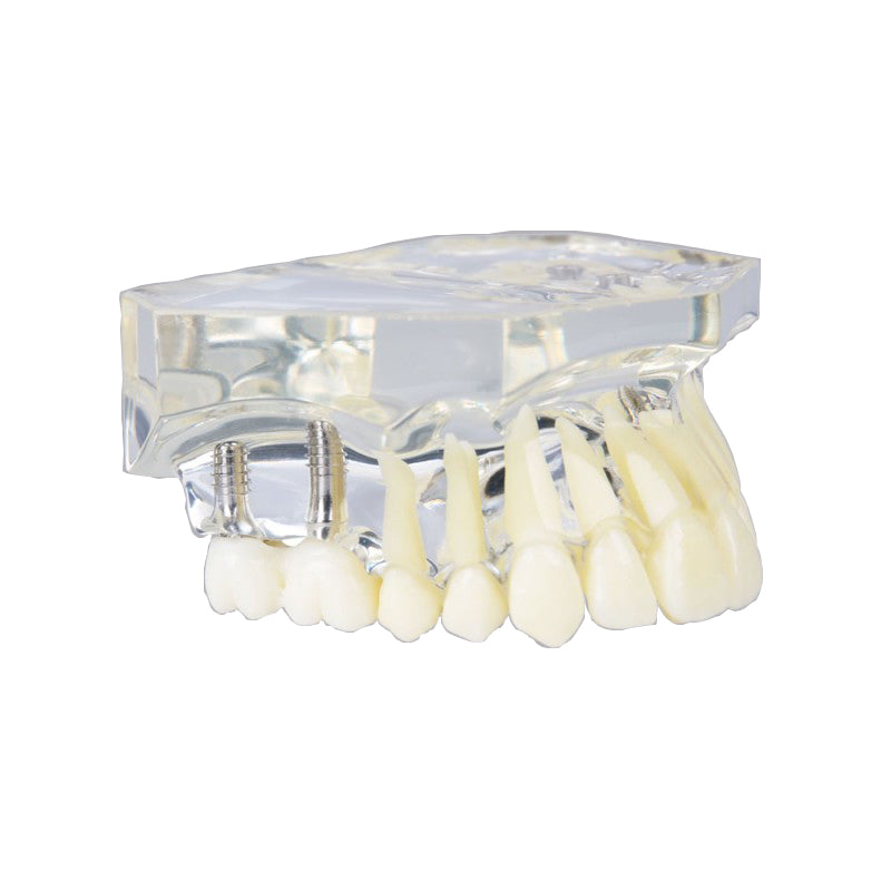 W2011 Dental Implant Model Maxillary Model with Crown and Implant