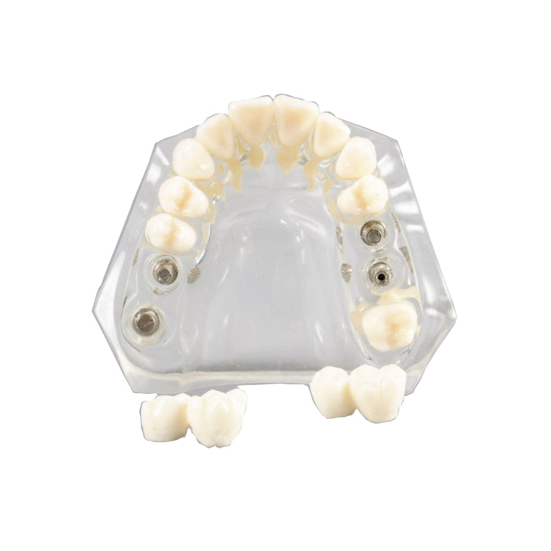 W2011 Dental Implant Model Maxillary Model with Crown and Implant – Dr ...