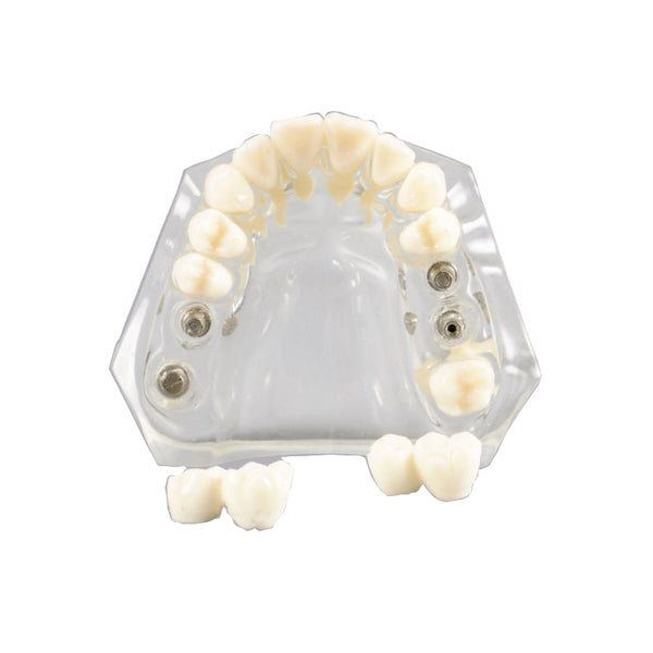 W2011 Dental Implant Model Maxillary Model with Crown and Implant