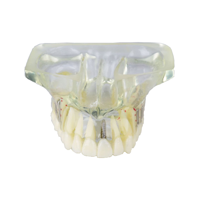 W2015 Dental Implant Model Upper Jaw Model Restoration Model