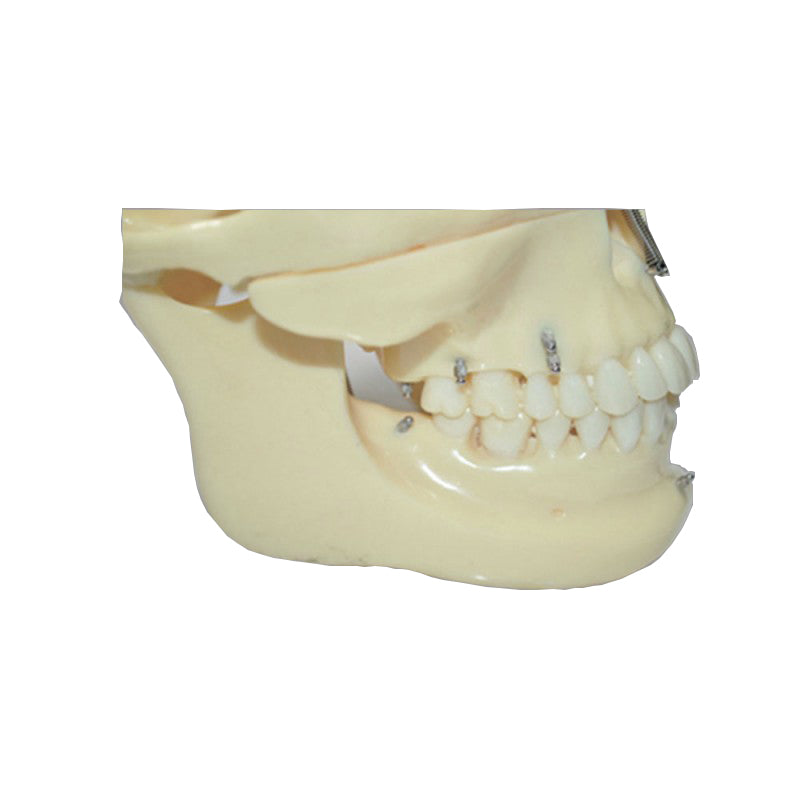 W2016 Dental Orthodontic Implant Model