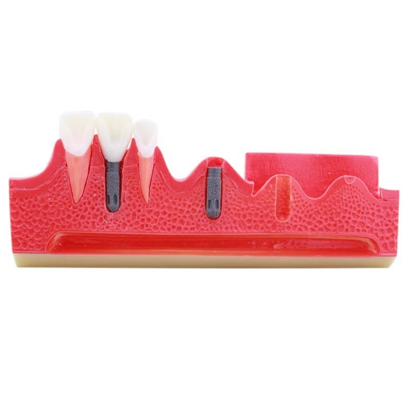 W2018 Steps for Implant Demonstration Model