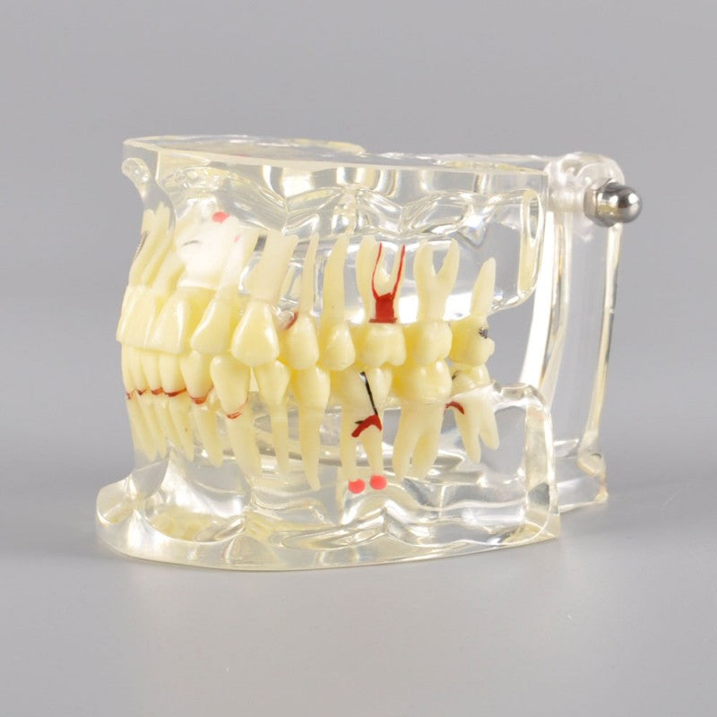 W4001-2 Adult Dental Pathological Model-Missing Tooth