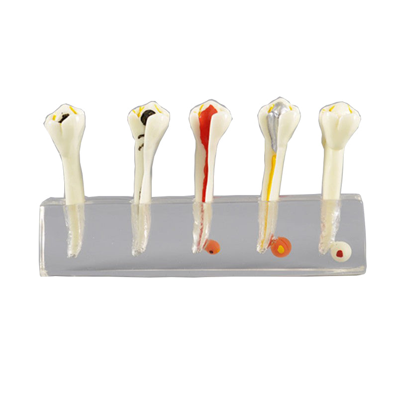 W4007 Dental Endodontic Model with Restoration