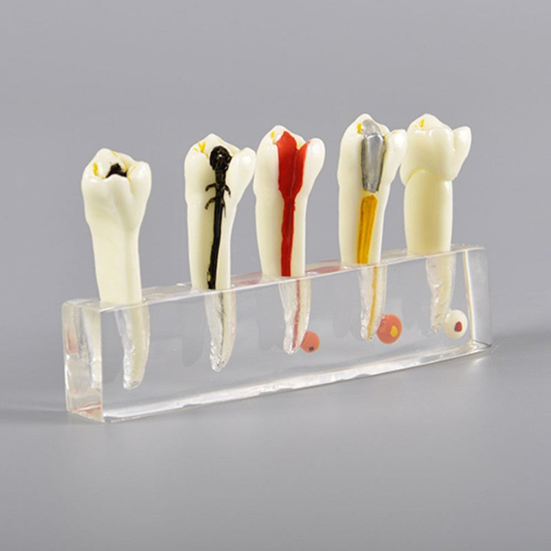 W4007 Dental Endodontic Model with Restoration – Dr Wong Anatomy