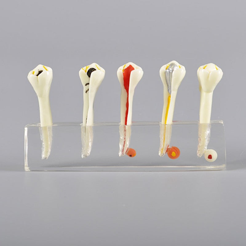 W4007 Dental Endodontic Model with Restoration