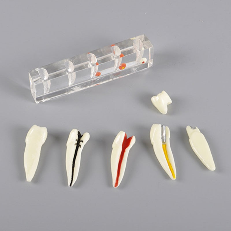 W4007 Dental Endodontic Model with Restoration