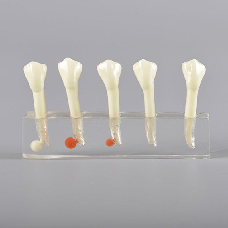 W4007 Dental Endodontic Model with Restoration – Dr Wong Anatomy