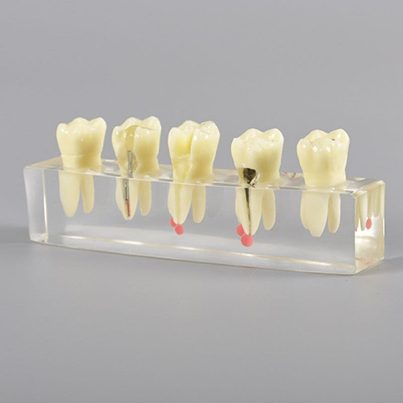 W4012 Dental Root Canal Model with Restoration