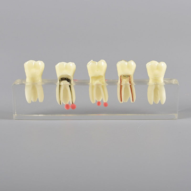 W4012 Dental Root Canal Model with Restoration