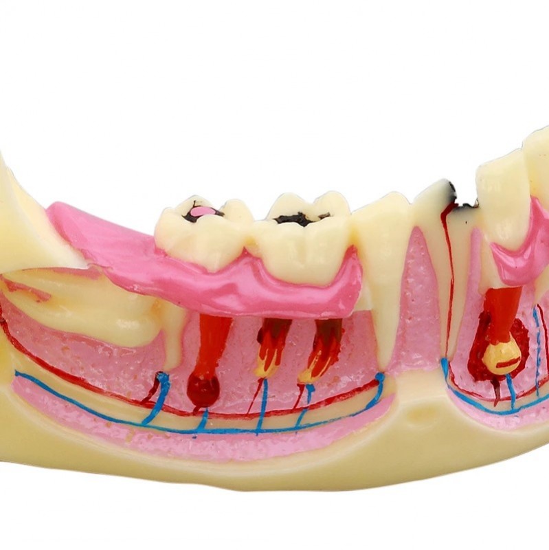 W4014 Dental Mandible Model with Caries