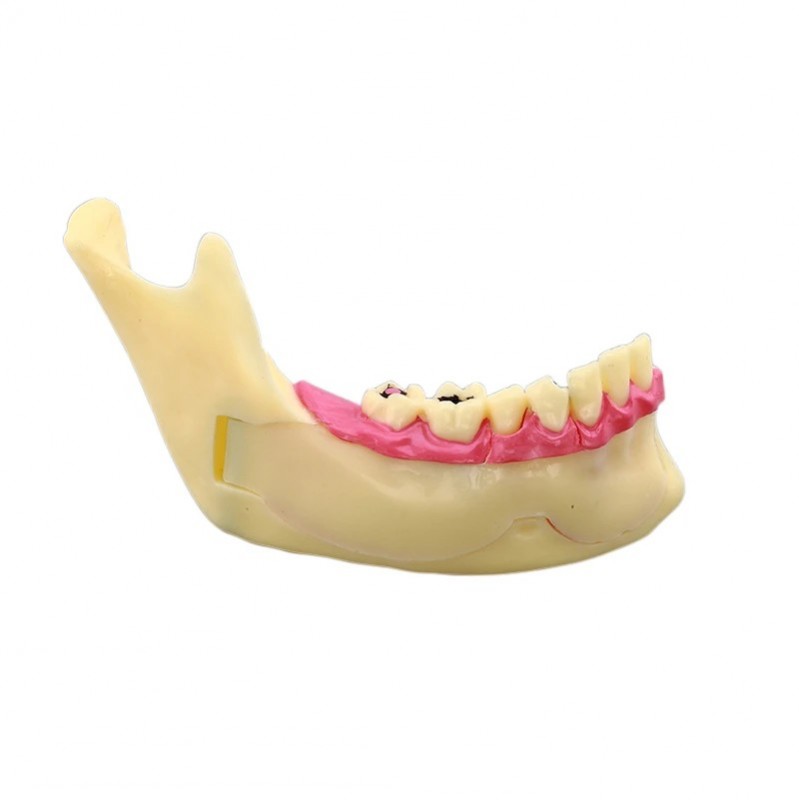 W4014 Dental Mandible Model with Caries