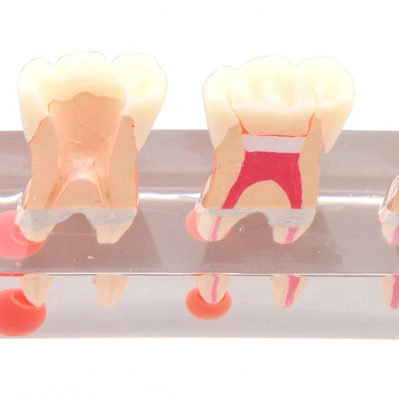W4018 Dental Endodontic Treatment Model – Dr Wong Anatomy