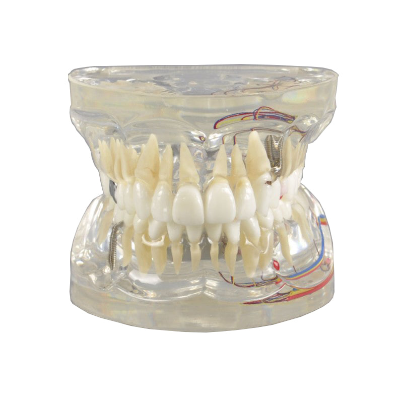 W4019-2 Dental Pathology Model with Nerve