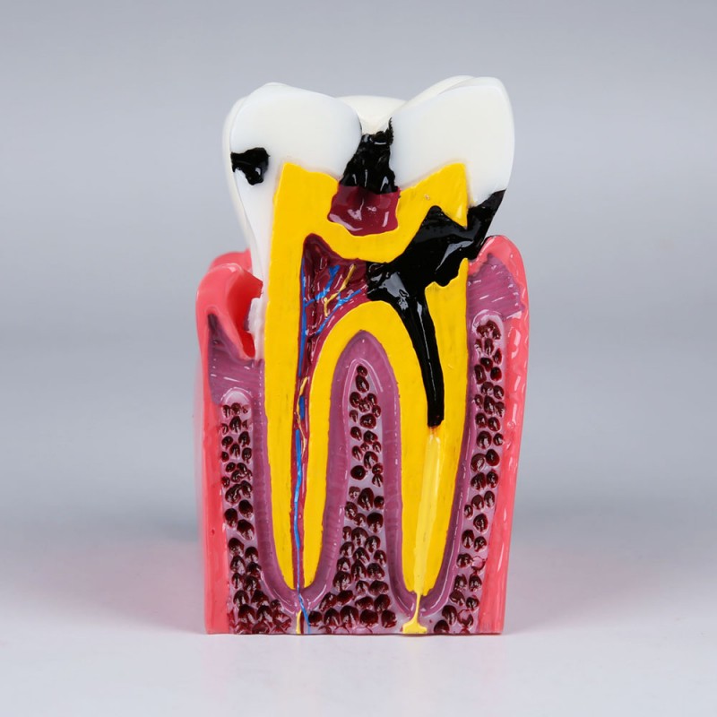W4021 Dental Caries Model Compares Healthy and Caries Tooth