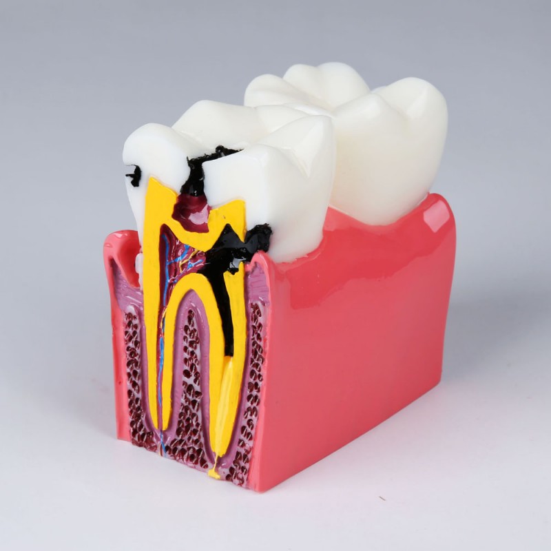 W4021 Dental Caries Model Compares Healthy and Caries Tooth