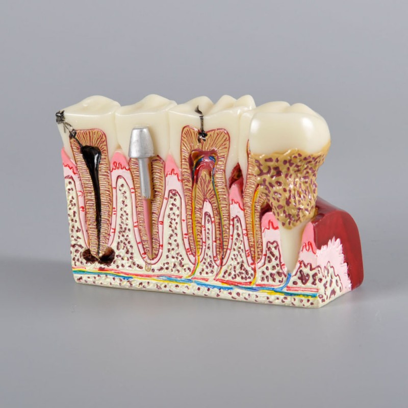 W4029 Dental Pathology Model with Kinds of Cases