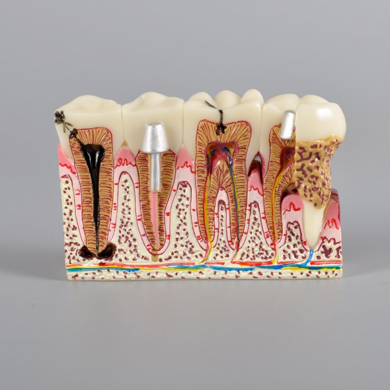 W4029 Dental Pathology Model with Kinds of Cases