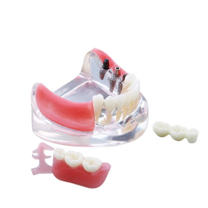 W6006 Dental Implant Model with Restoration – Dr Wong Anatomy