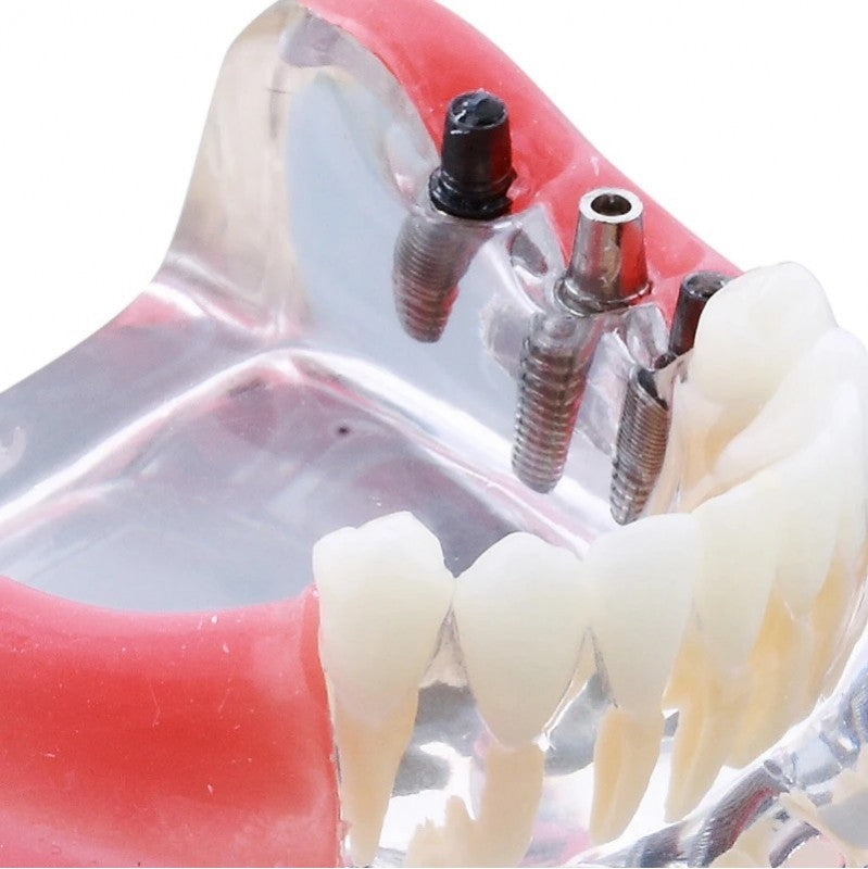 W6006 Dental Implant Model with Restoration