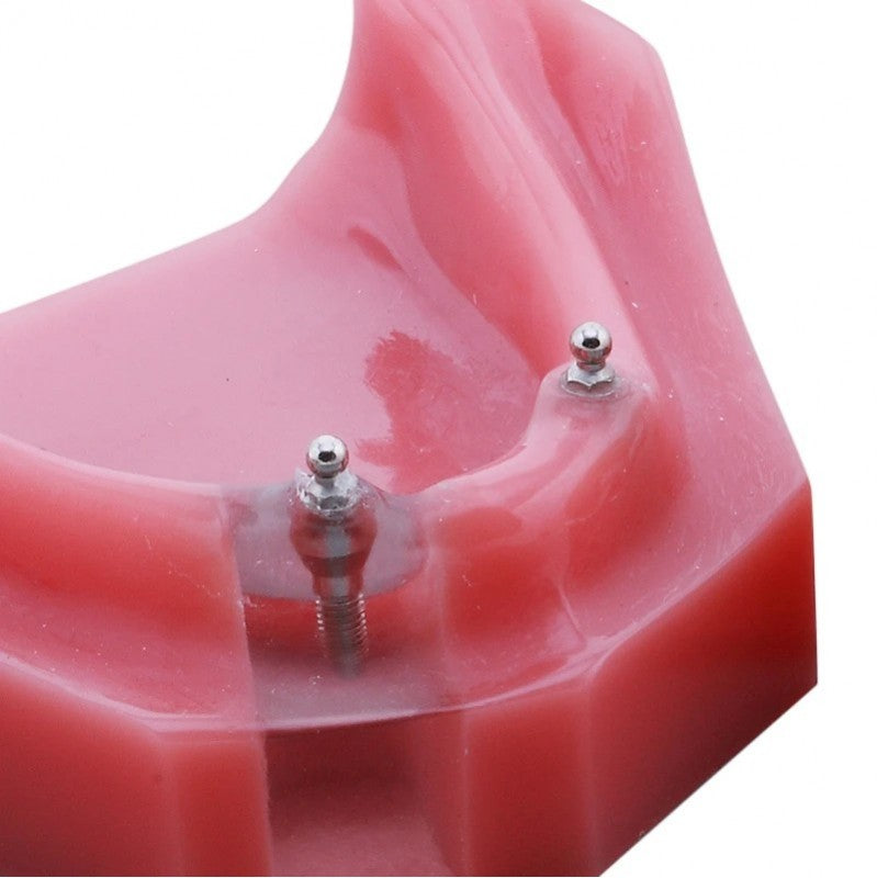 W6007 Dental Overdenture Model with 2 Implants